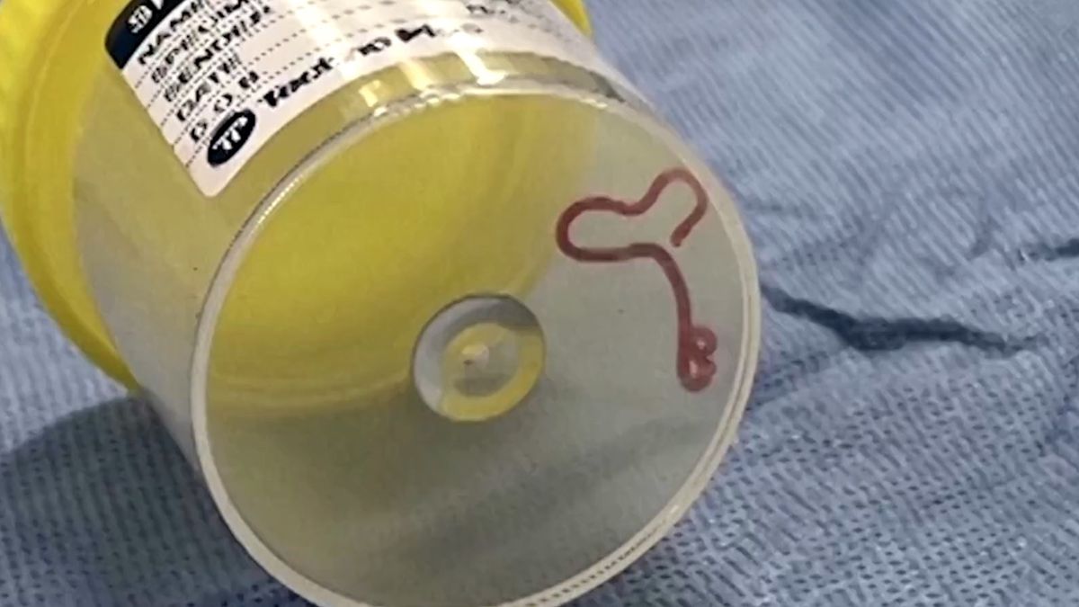 Première mondiale: Un ver parasite vivant découvert dans le cerveau d ...