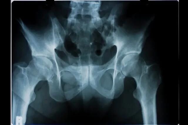 Ostéoporose: les hommes sont-ils à risque? Réponse des HUG | Tribune de ...