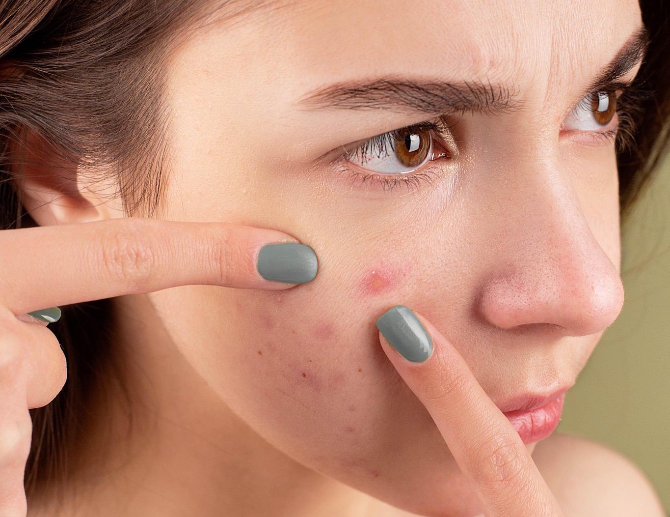 Life&Style: Pusteln im Erwachsenenalter: Mit welchem Mittel man Pickel ...