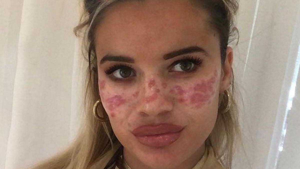 Tilly Whitfield – TV-Star leidet nach Tiktok-Beauty-Hack an Sehverlust ...