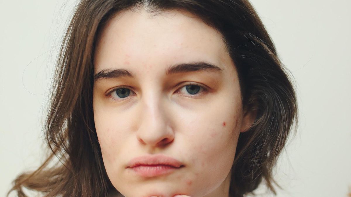 Dermatologin verrät: Das bedeuten die Pickel in deinem Gesicht - L ...