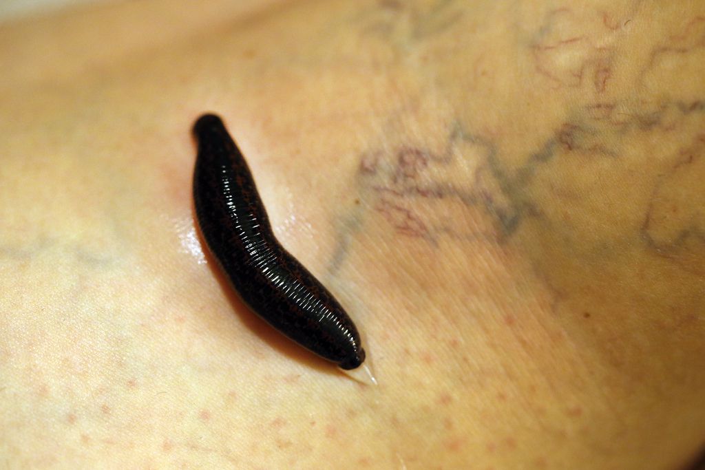 Heilende Blutsauger | Berner Zeitung