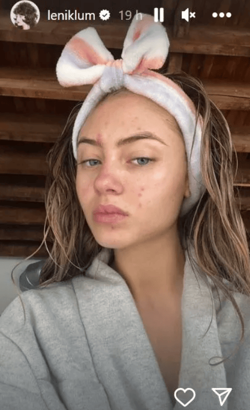 S’assumer au naturel: Leni Klum affiche fièrement son acné - L'essentiel