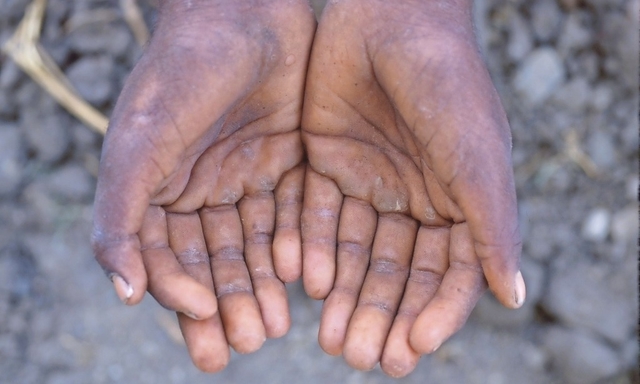 Sechs Finger an jeder Hand | Tages-Anzeiger