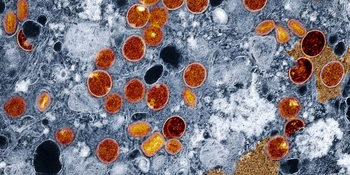 Virus der Klade Ib: Neue Mpox-Variante in der Schweiz