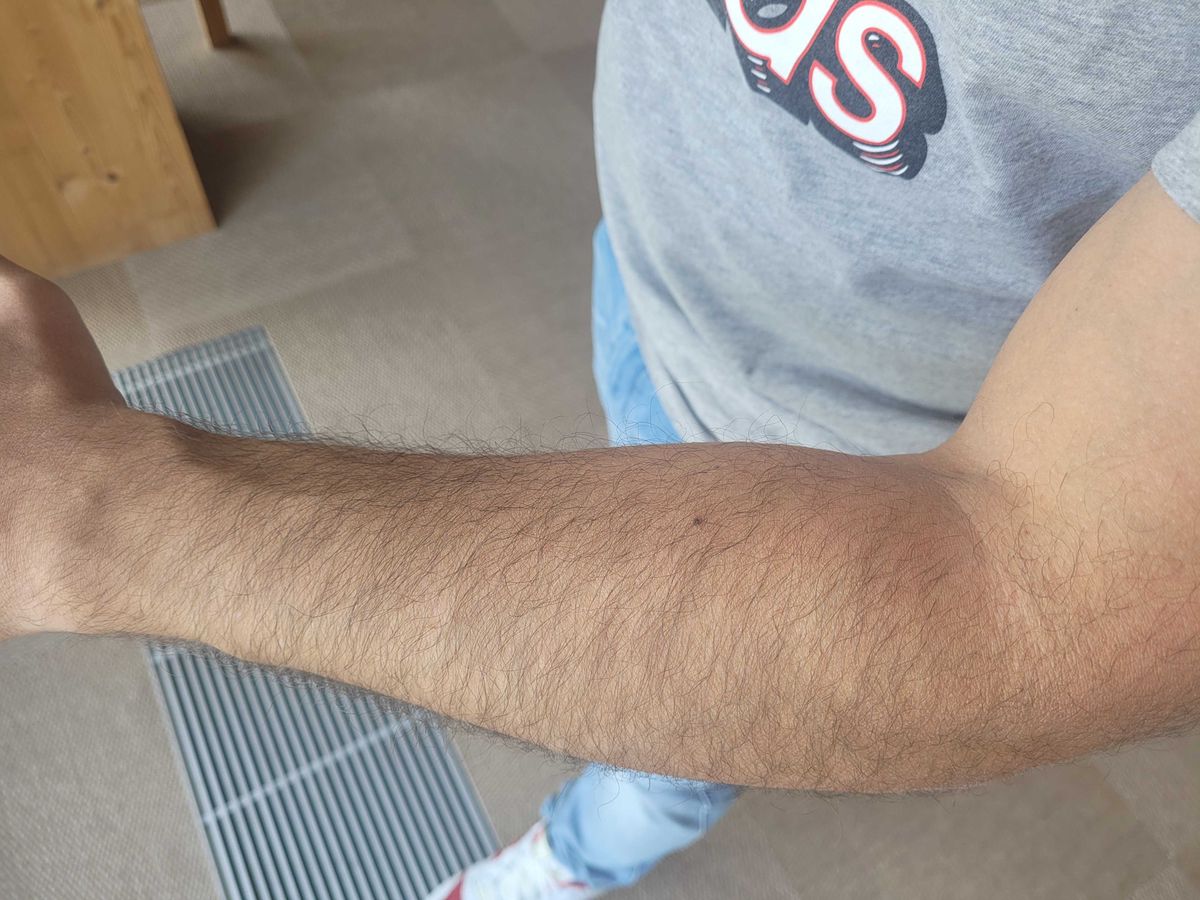 Social Media: Warum haben alle Männer dieses Muttermal auf dem Unterarm? - L'essentiel