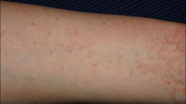 Santé – La gale, maladie effrayante qui fait son retour - L'essentiel