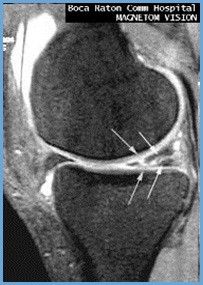 Meniskusriss – kleiner Schaden mit Konsequenzen | Tages-Anzeiger