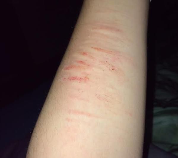 Selbstverletzung: «Ritzen gilt bei einigen Teenagern als cool» - 20 Minuten