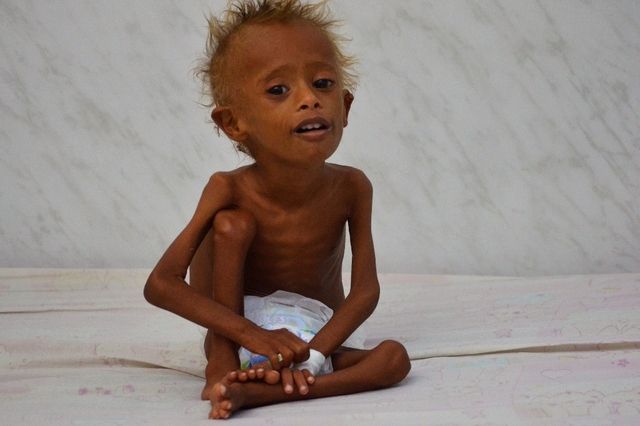 Rapport: Malnutrition: l'UNICEF dévoile des chiffres effarants - Le Matin