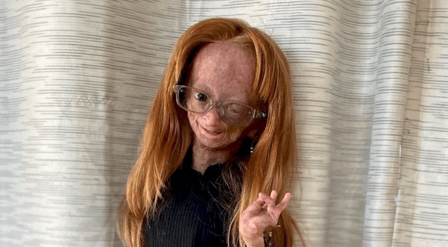 La youtubeuse Adalia Rose est morte à l’âge de 15 ans - Le Matin